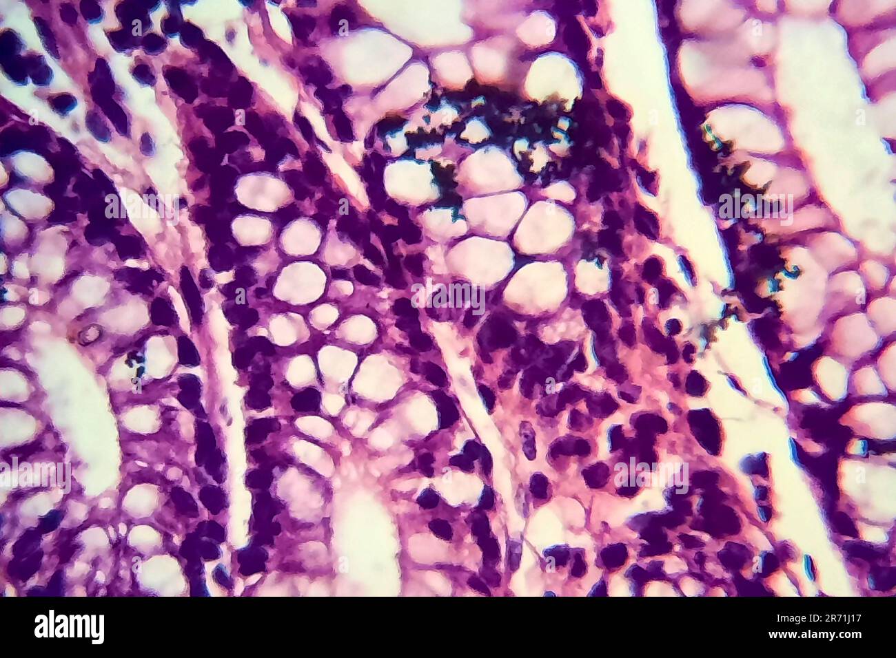 Bacillary dysentery, light micrograph, photo under microscope showing ...