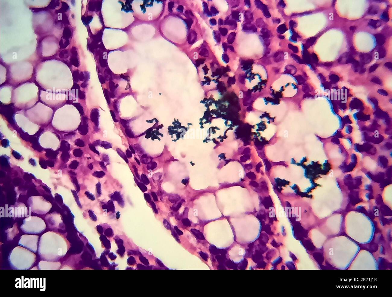 Bacillary dysentery, light micrograph, photo under microscope showing ...