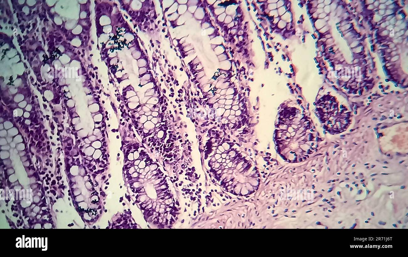 Bacillary dysentery, light micrograph, photo under microscope showing ...