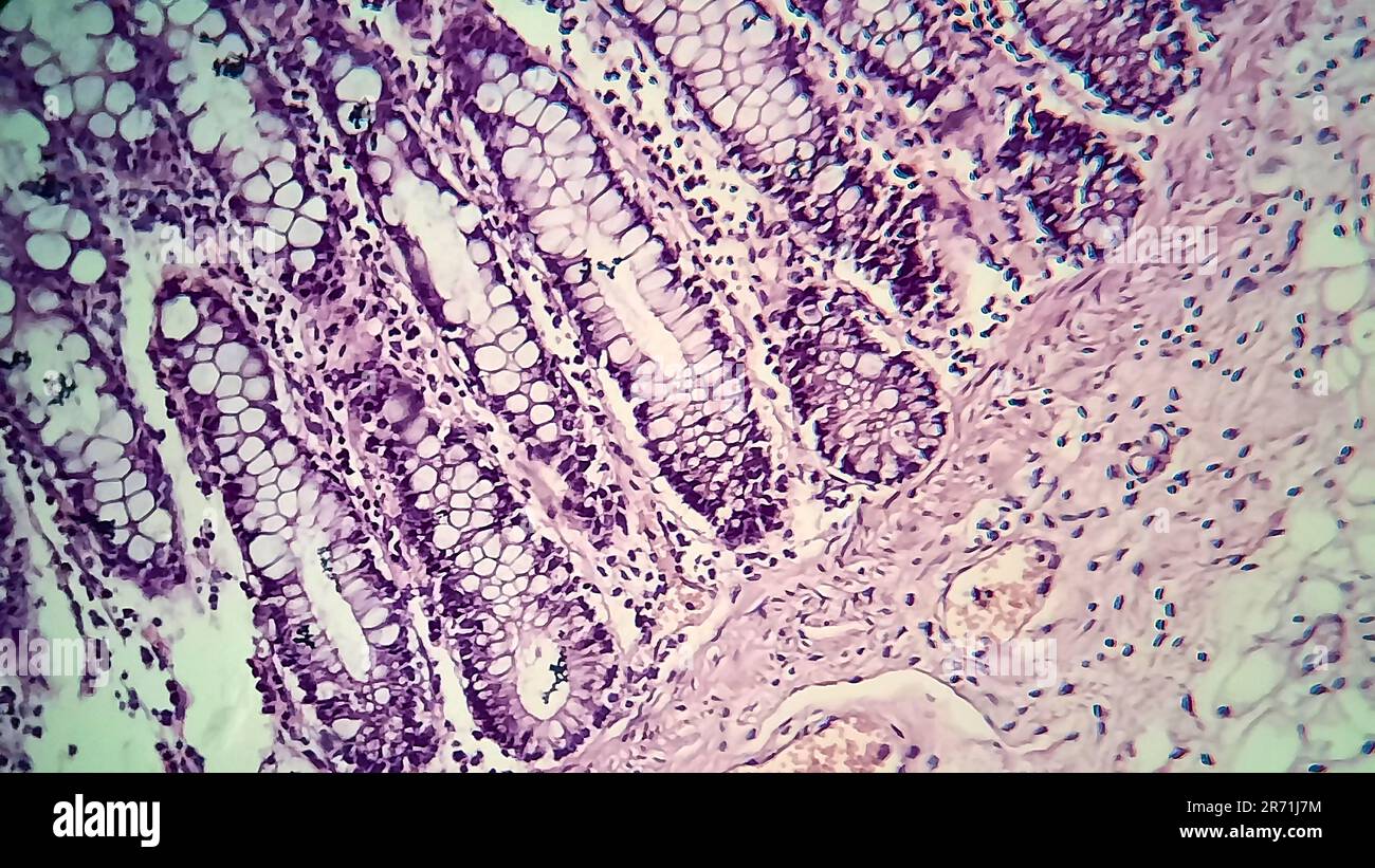 Bacillary dysentery, light micrograph, photo under microscope showing ...