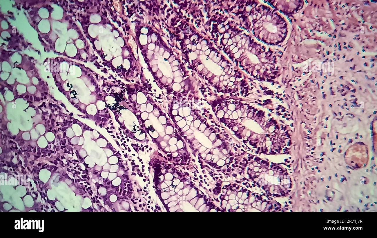 Bacillary dysentery, light micrograph, photo under microscope showing ...