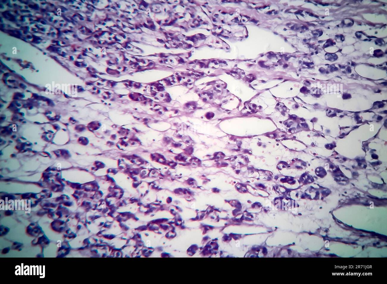 Thyroid follicular carcinoma, light micrograph, photo under microscope ...
