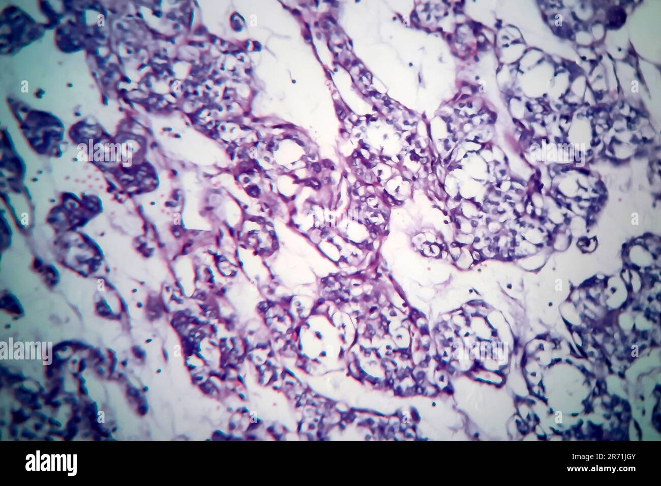 Thyroid follicular carcinoma, light micrograph, photo under microscope ...