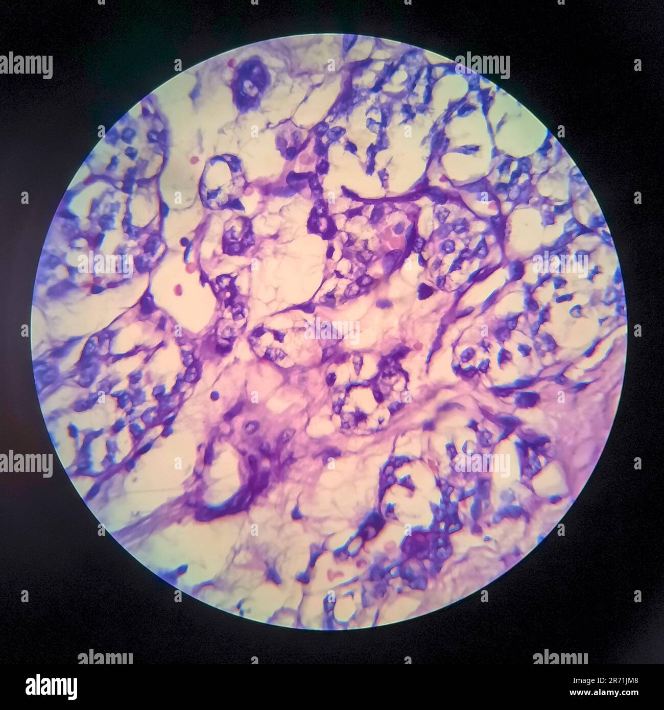 Thyroid follicular carcinoma, light micrograph, photo under microscope ...