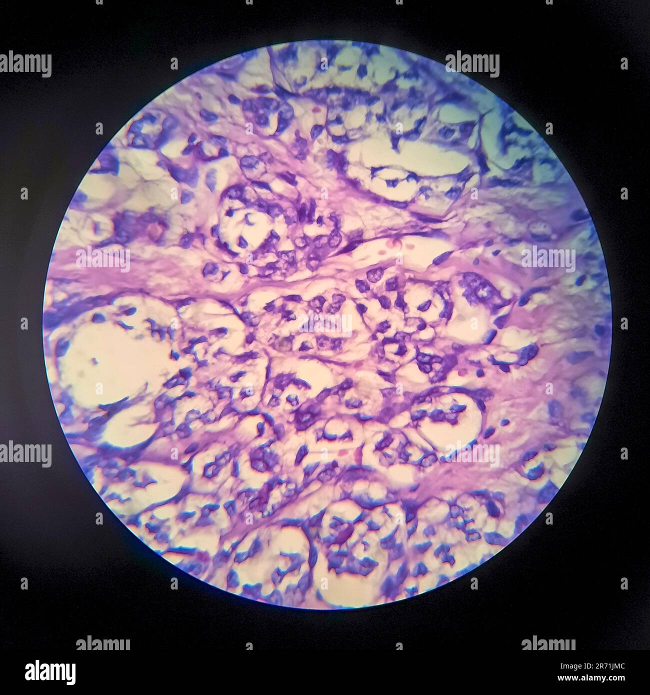 Thyroid follicular carcinoma, light micrograph, photo under microscope ...