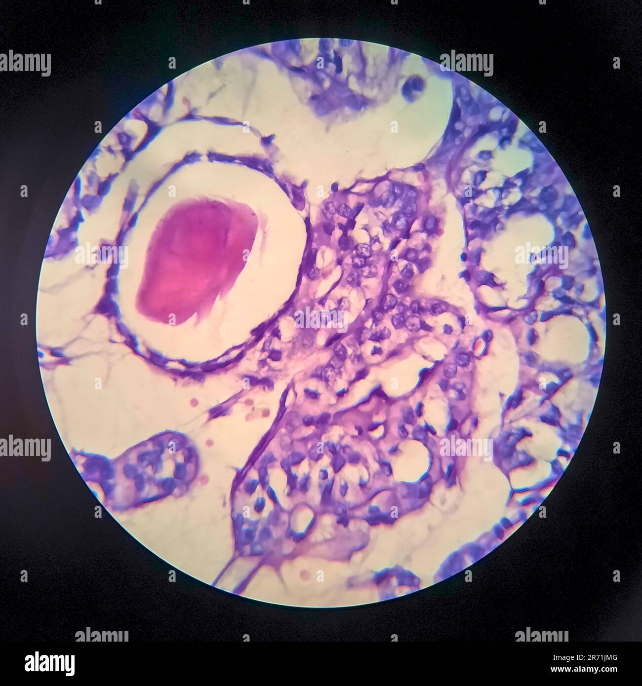 Thyroid follicular carcinoma, light micrograph, photo under microscope ...