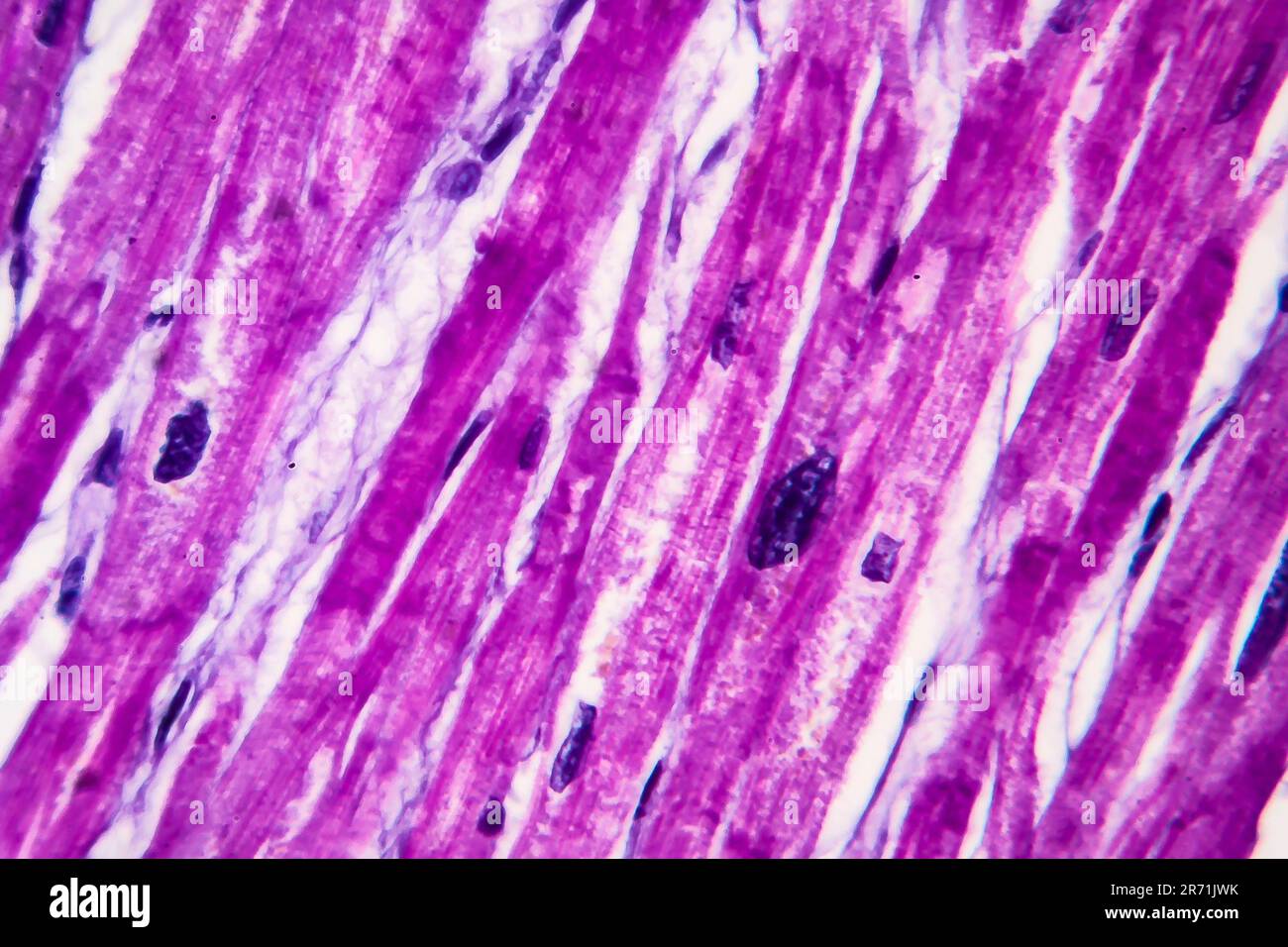 Histopathology Of Heart Hypertrophy High Magnification