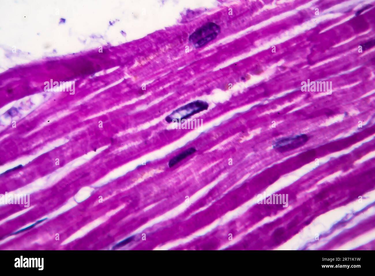 Histopathology of heart hypertrophy, high magnification ...