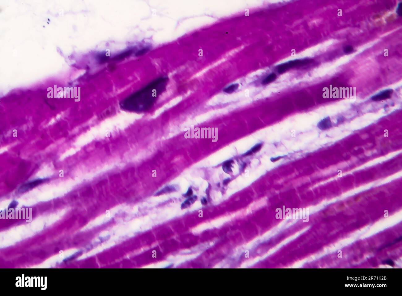 Histopathology of heart hypertrophy, high magnification ... Histopathology of heart hypertrophy, high magnification ...
