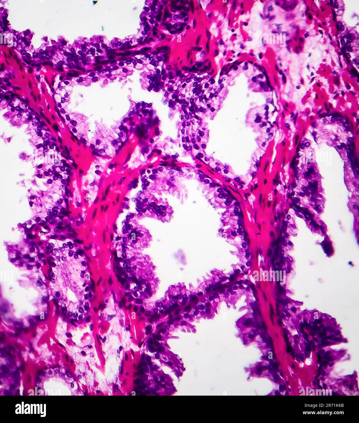 Benign Prostatic Hyperplasia Light Micrograph Photo Under Microscope