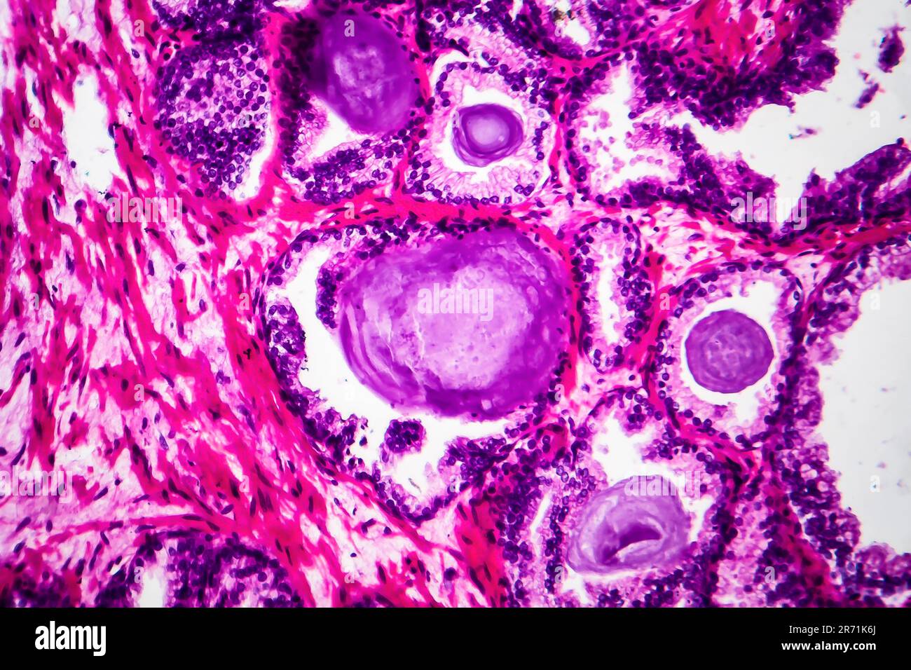 Benign Prostatic Hyperplasia Light Micrograph Photo Under Microscope