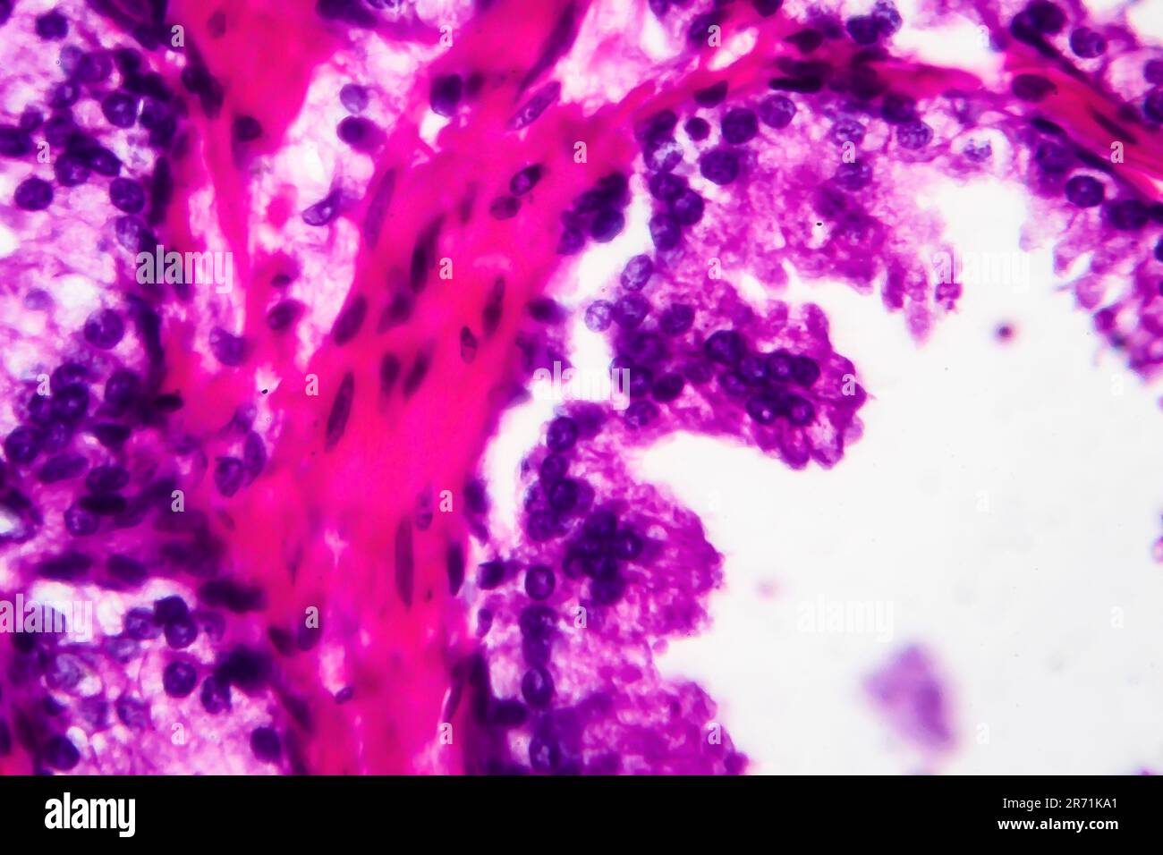 Benign Prostatic Hyperplasia Light Micrograph Photo Under Microscope