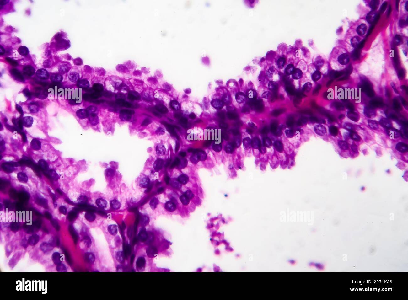 Benign prostatic hyperplasia, light micrograph, photo under microscope ...