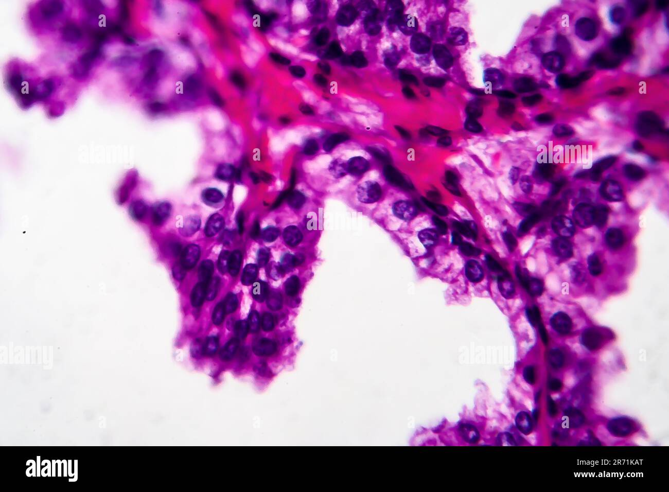 Benign prostatic hyperplasia, light micrograph, photo under microscope ...