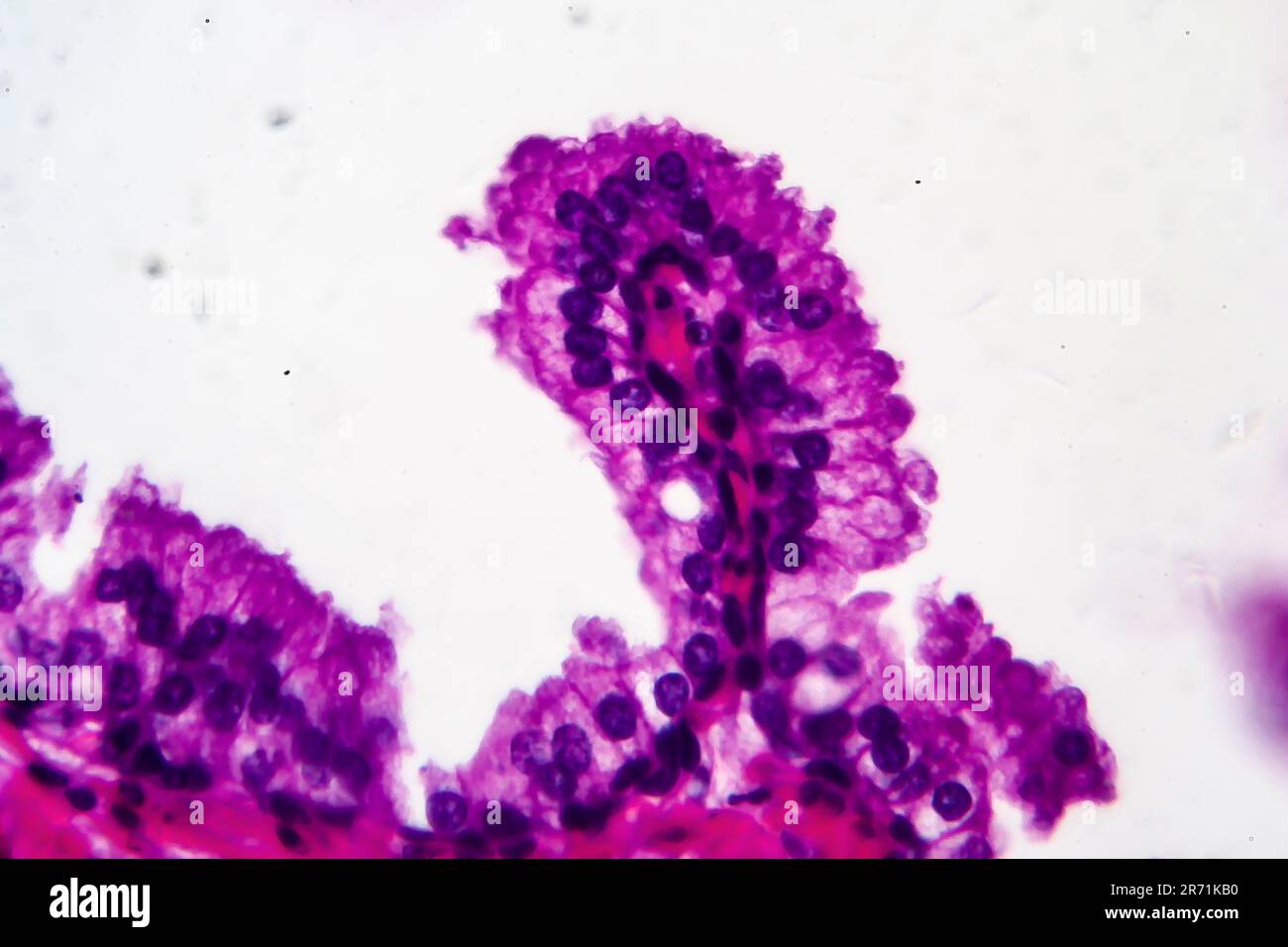 Benign prostatic hyperplasia, light micrograph, photo under microscope ...