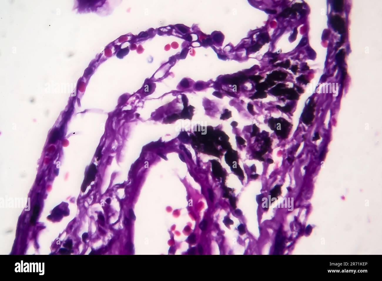 Histopathology of smoker's lung. Light micrograph showing accumulation ...