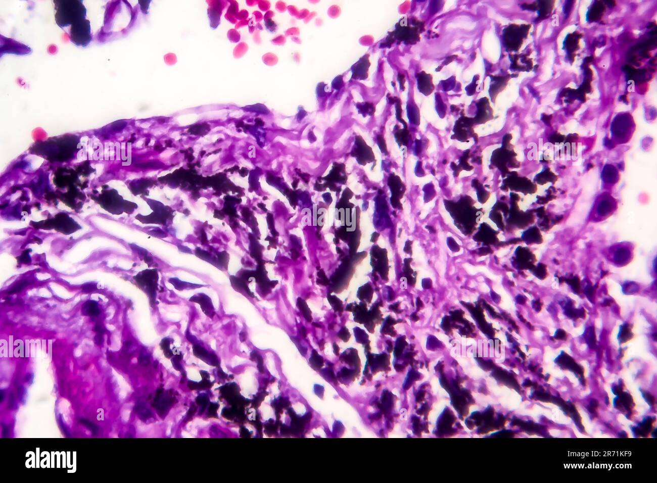 Histopathology of smoker's lung. Light micrograph showing accumulation ...