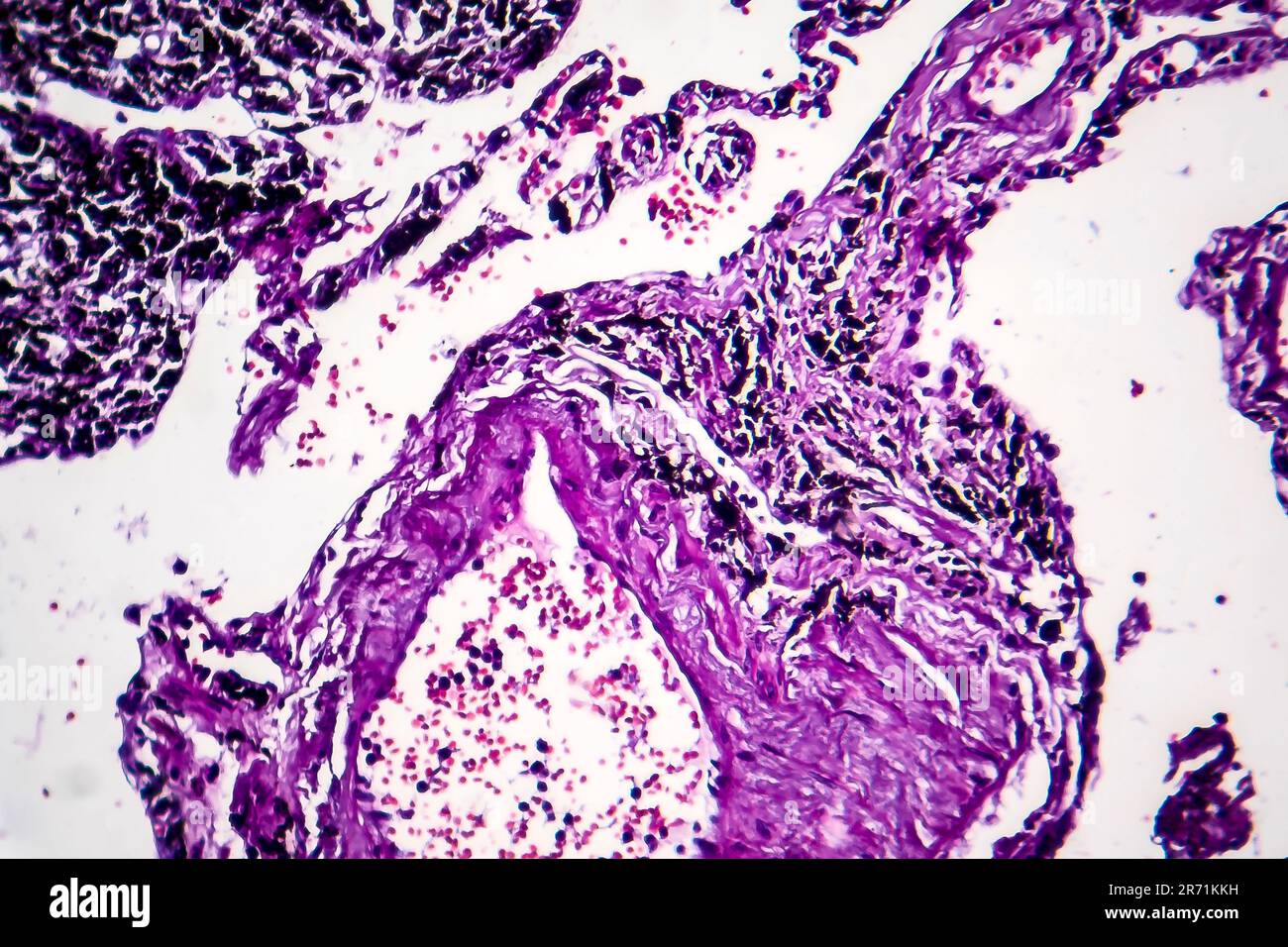 Histopathology of smoker's lung. Light micrograph showing accumulation ...