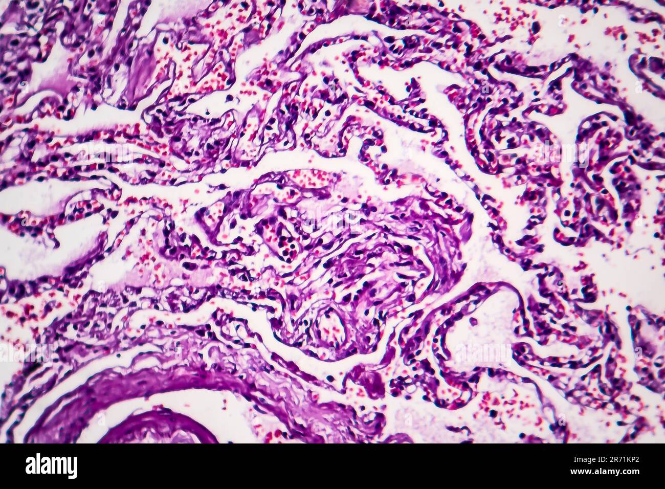 Histopathology of smoker's lung. Light micrograph showing accumulation ...