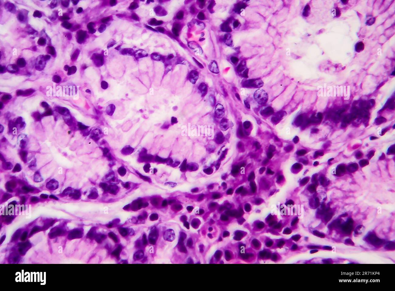 Histopathology of stomach adenocarcinoma, light micrograph, photo under ...