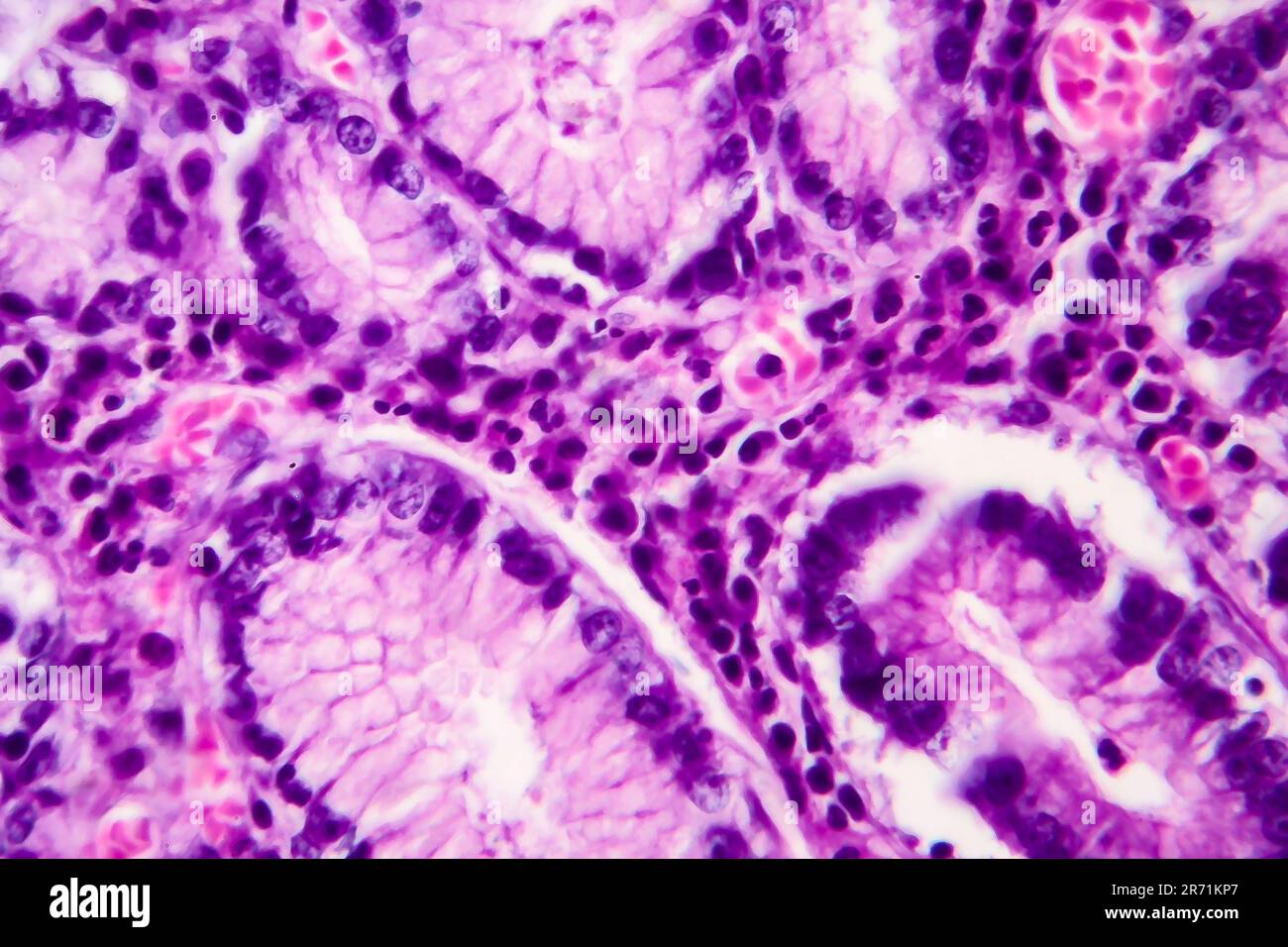Stomach cancer tissue under hi-res stock photography and images - Alamy