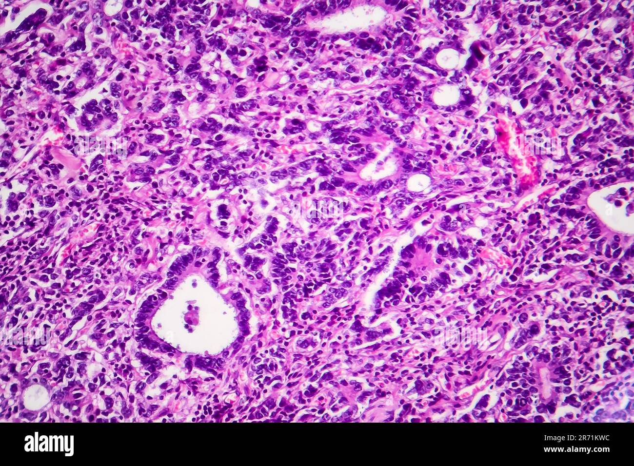 Cancer micrograph epithelial hi-res stock photography and images - Alamy