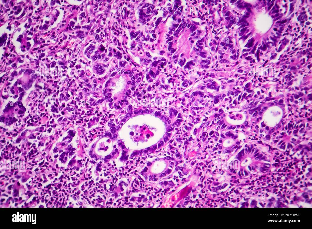 Gastric adenocarcinoma, light micrograph, photo under microscope Stock ...