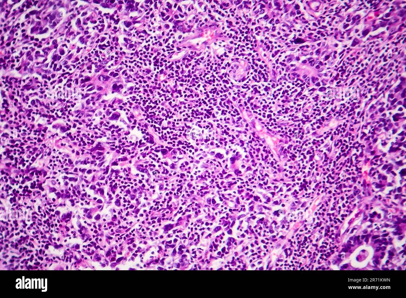 Gastric pathology hi-res stock photography and images - Alamy