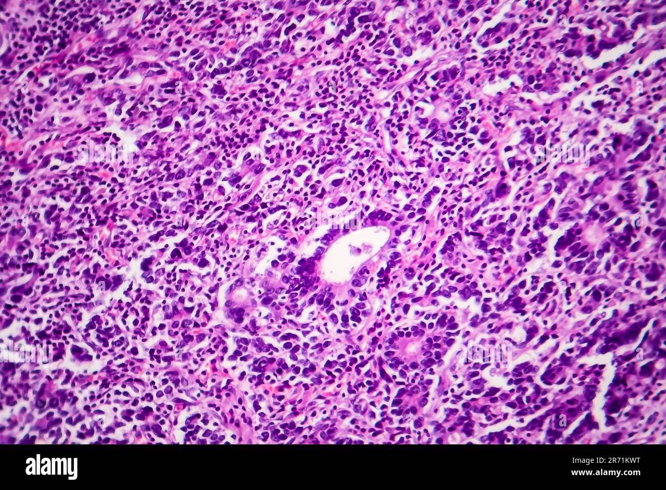 Gastric adenocarcinoma, light micrograph, photo under microscope Stock ...