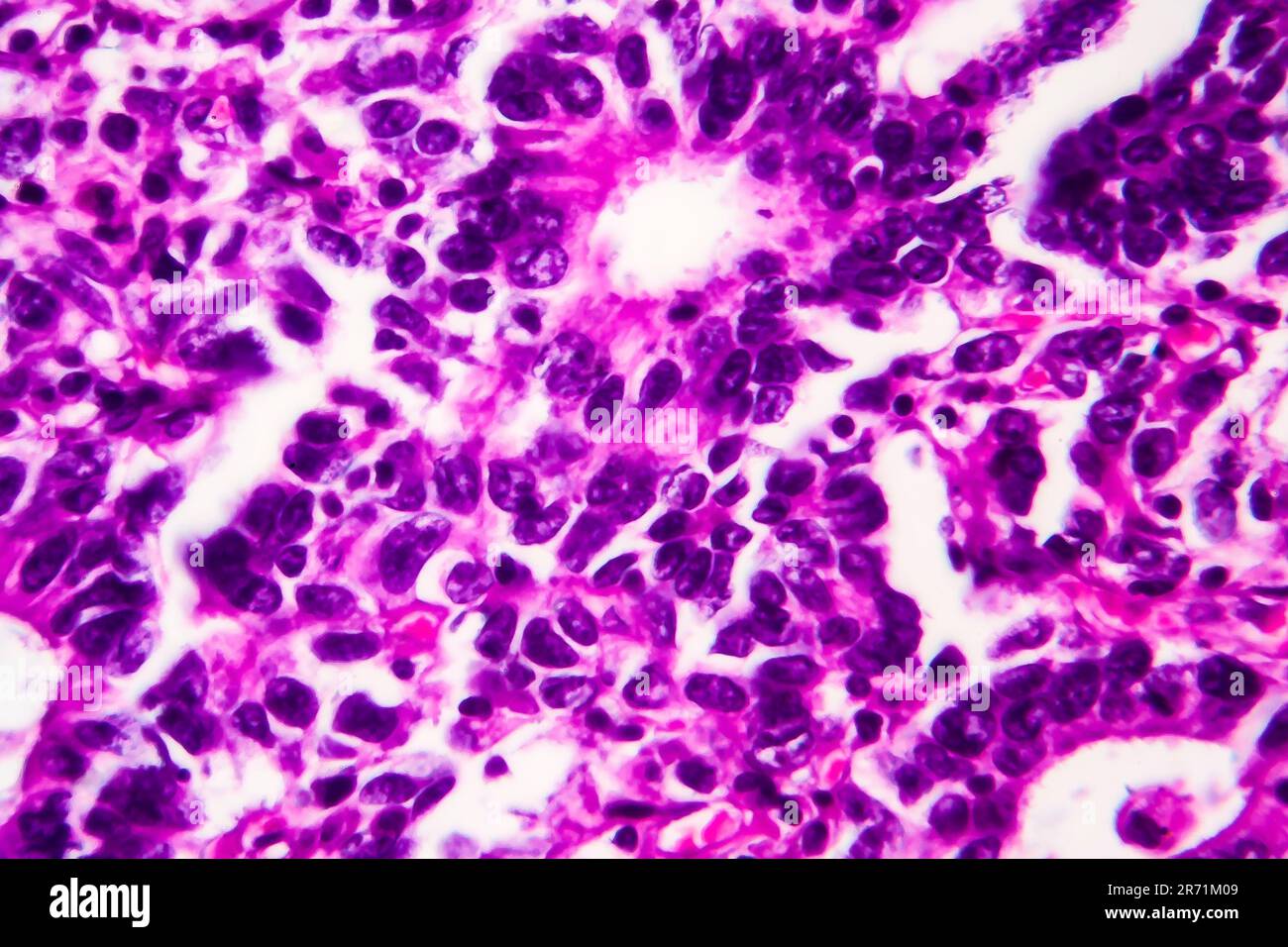 Cancer micrograph epithelial hi-res stock photography and images - Alamy