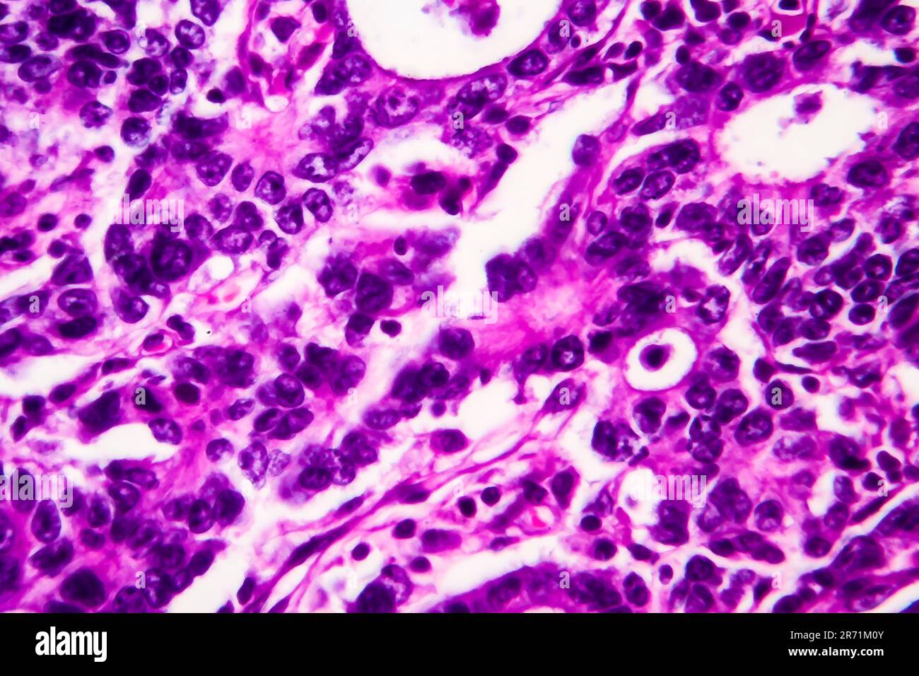 Gastric adenocarcinoma, light micrograph, photo under microscope. High ...