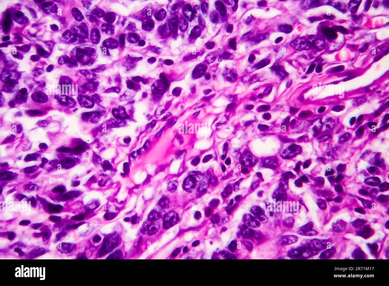 Cancer micrograph epithelial hi-res stock photography and images - Alamy