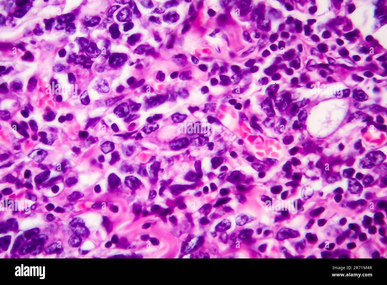 Gastric adenocarcinoma, light micrograph, photo under microscope. High ...