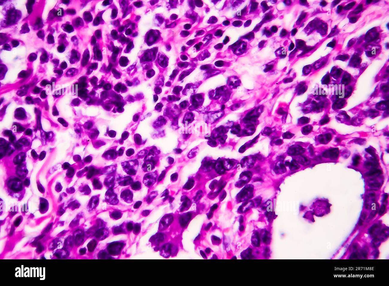 Cancer micrograph epithelial hi-res stock photography and images - Alamy