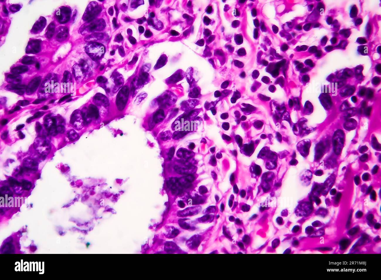 Cancer micrograph epithelial hi-res stock photography and images - Alamy