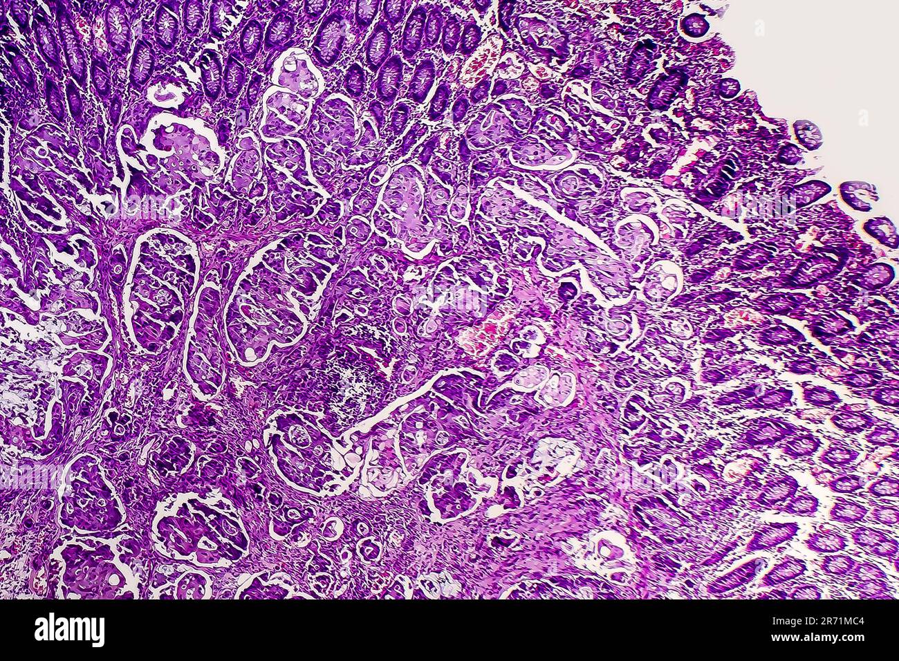 Poorly differentiated intestinal adenocarcinoma, light micrograph ...