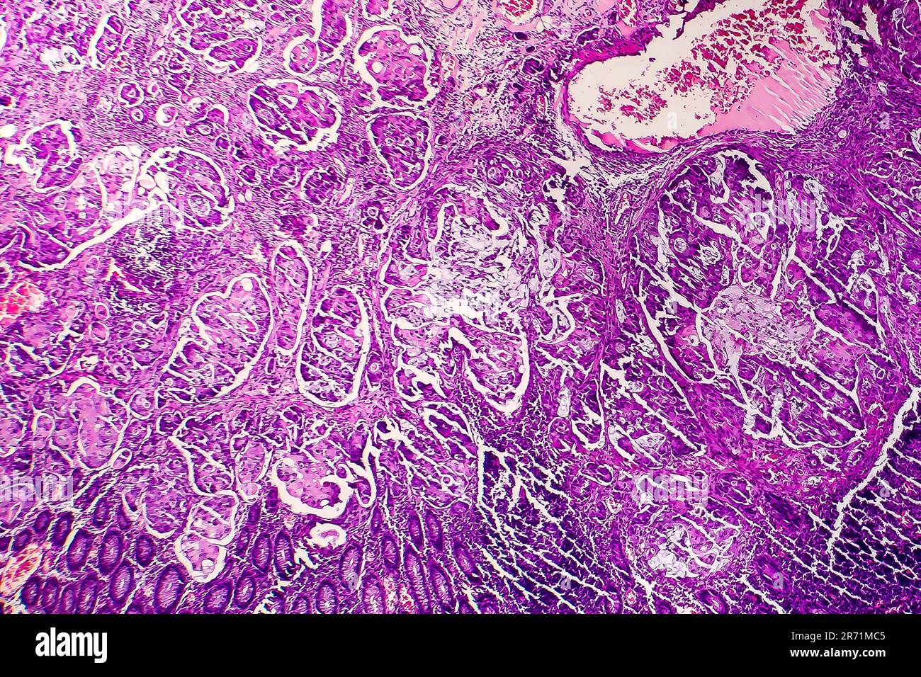Poorly differentiated intestinal adenocarcinoma, light micrograph ...