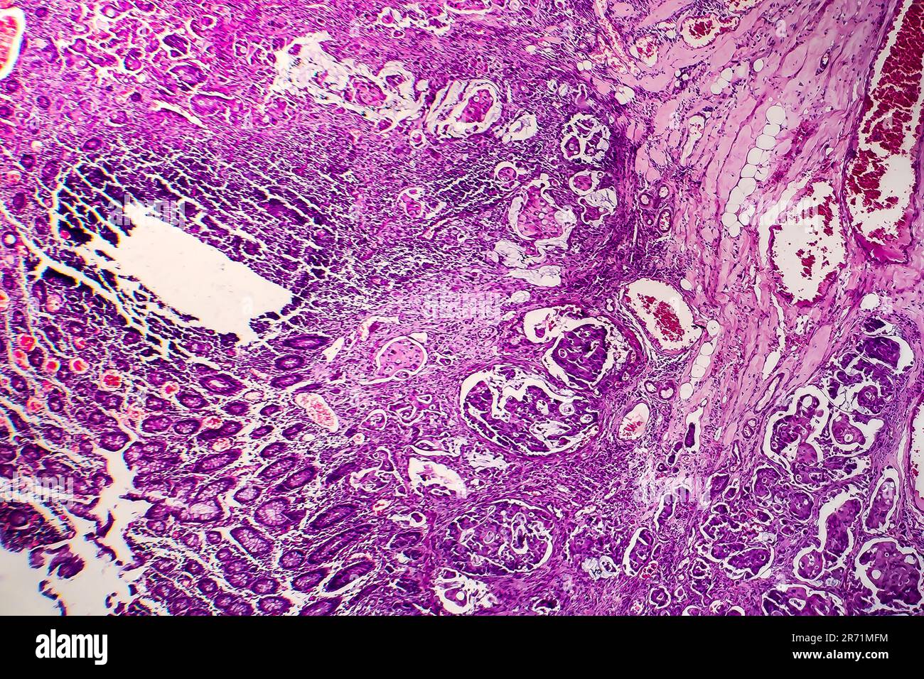 Poorly differentiated intestinal adenocarcinoma, light micrograph ...
