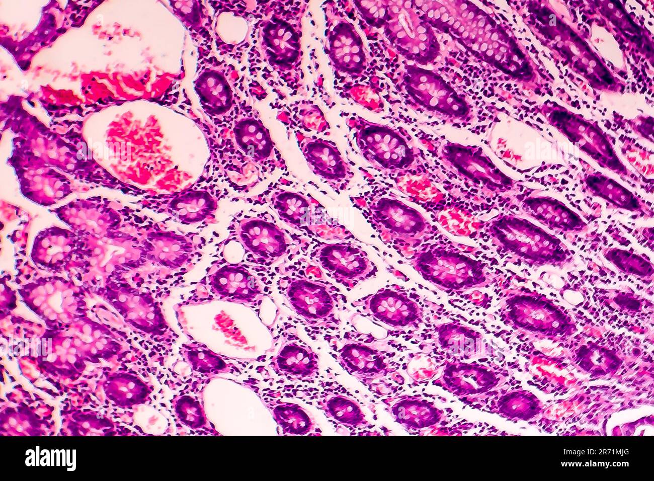 Poorly differentiated intestinal adenocarcinoma, light micrograph ...