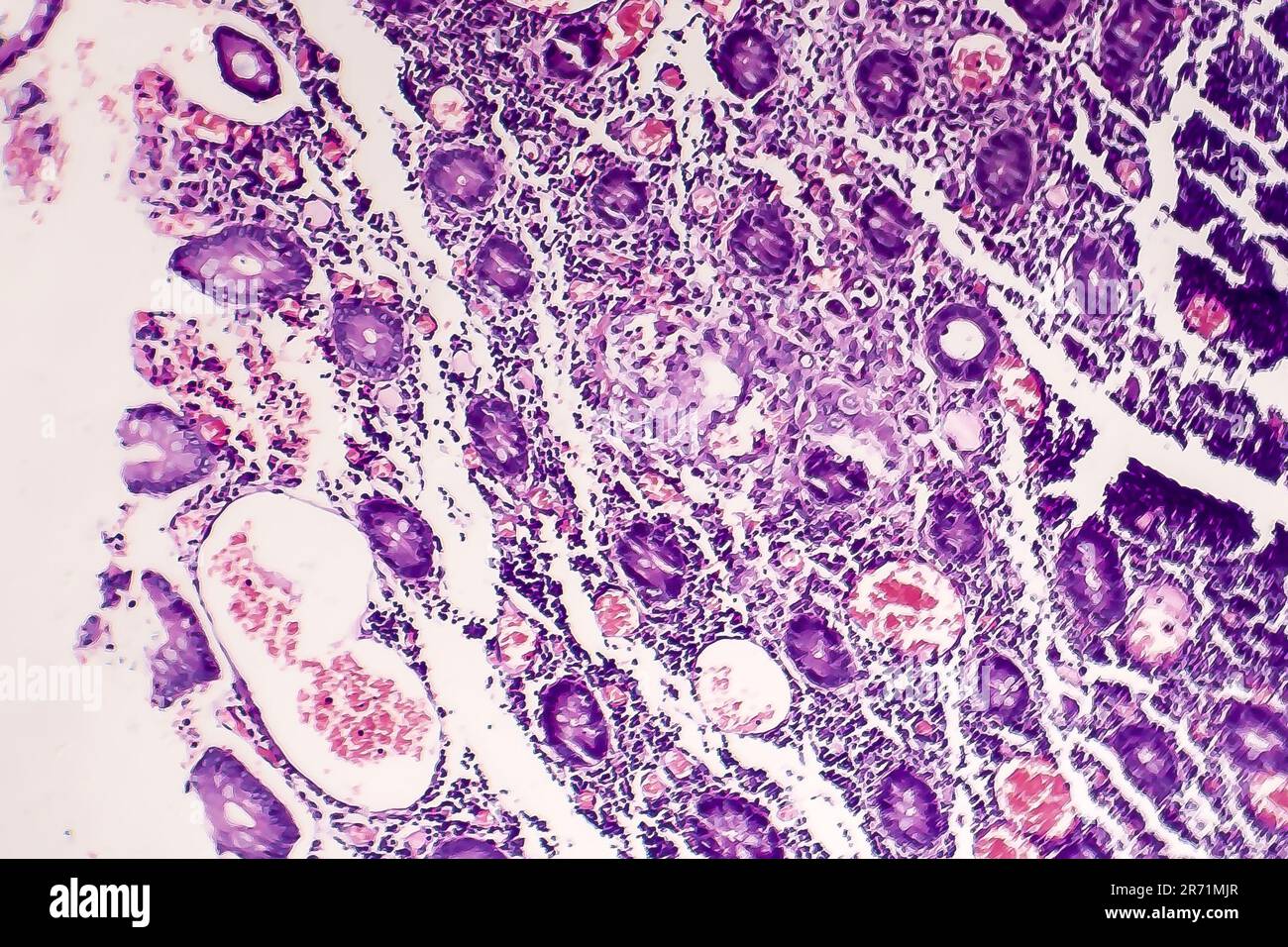 Poorly differentiated intestinal adenocarcinoma, light micrograph ...