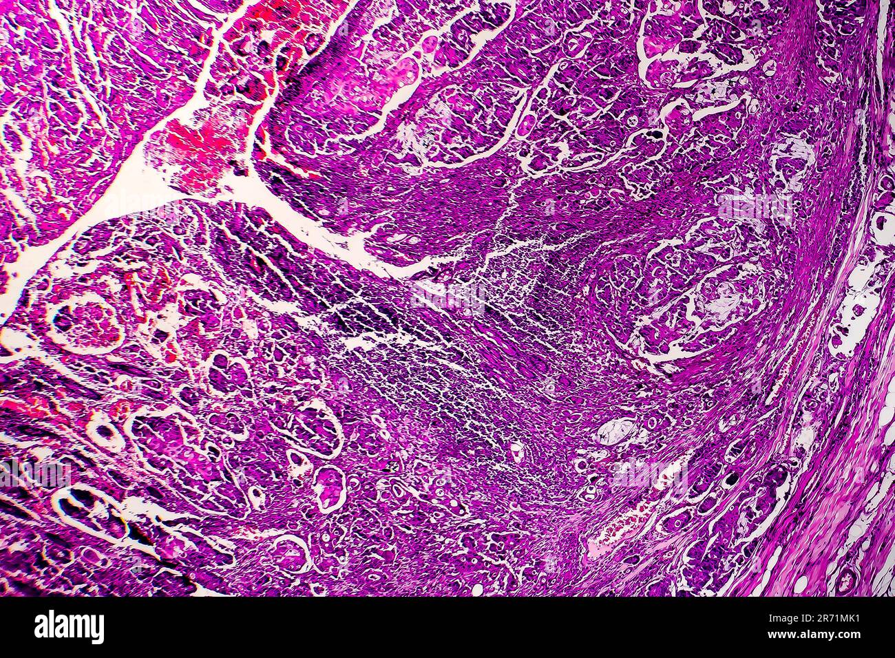 Poorly differentiated intestinal adenocarcinoma, light micrograph ...