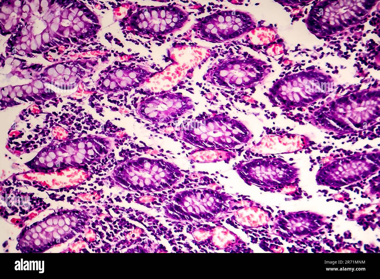 Poorly differentiated intestinal adenocarcinoma, light micrograph ...
