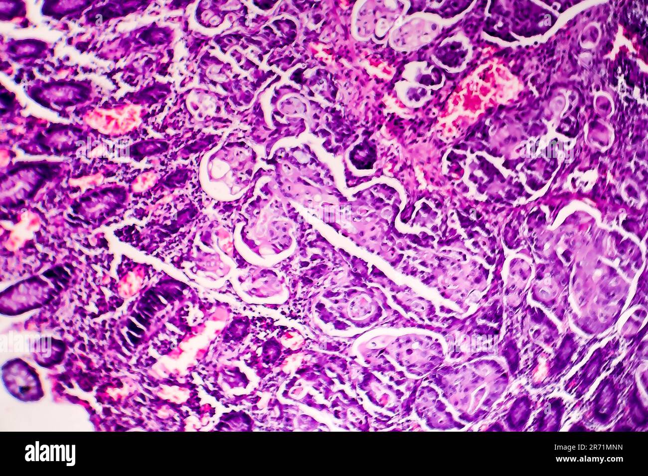 Poorly differentiated intestinal adenocarcinoma, light micrograph ...