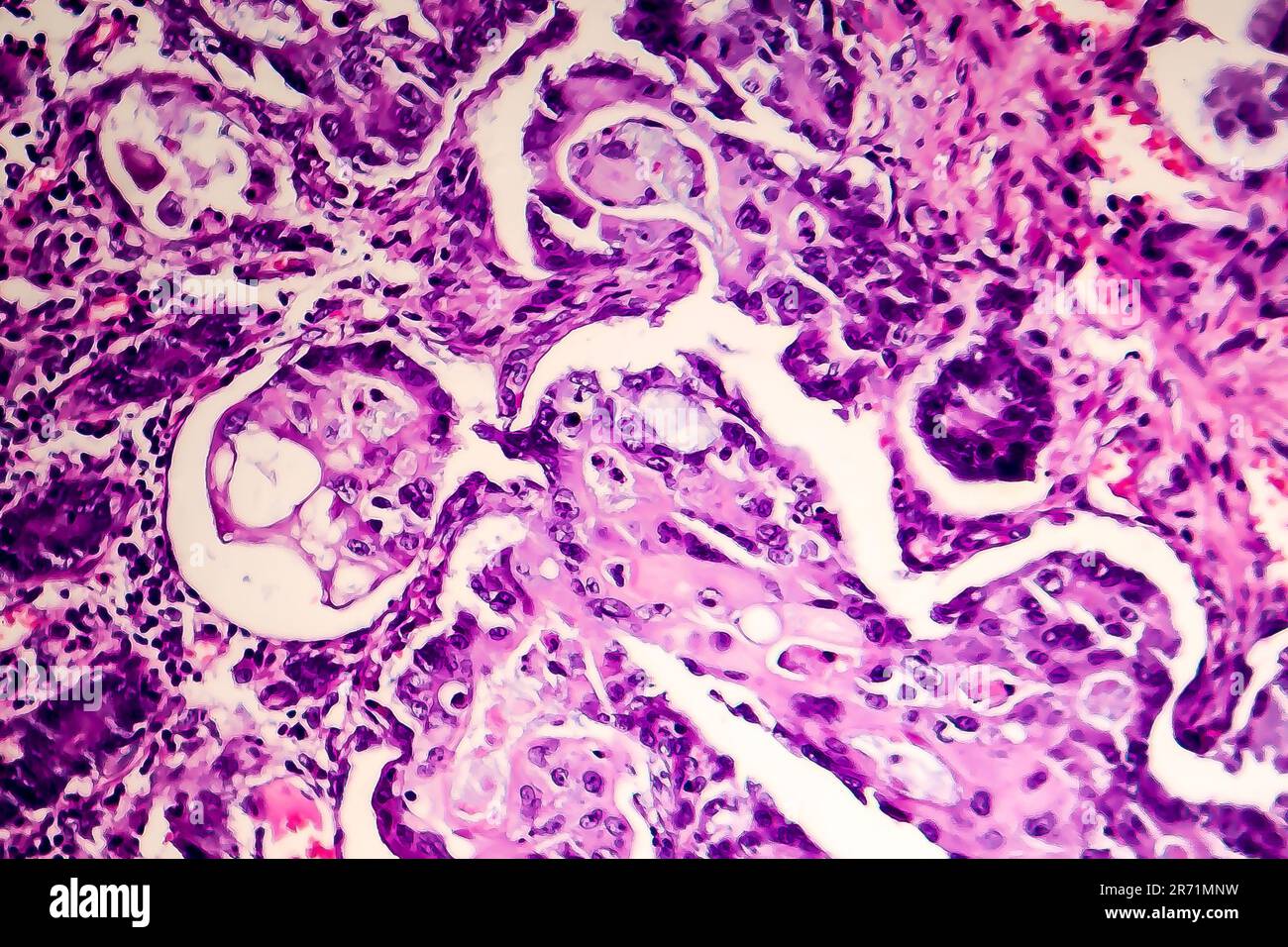 Poorly differentiated intestinal adenocarcinoma, light micrograph ...