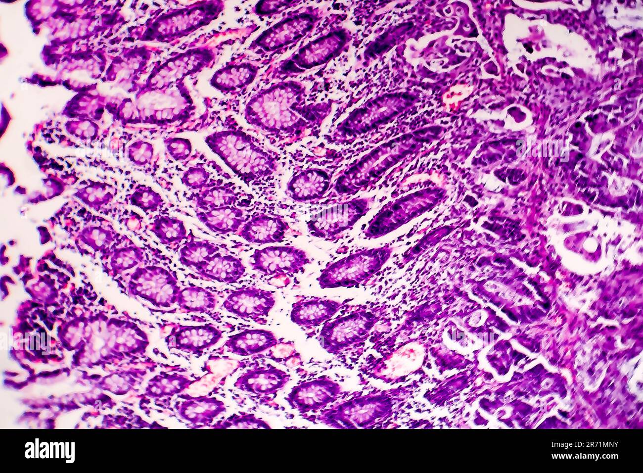 Poorly differentiated intestinal adenocarcinoma, light micrograph ...