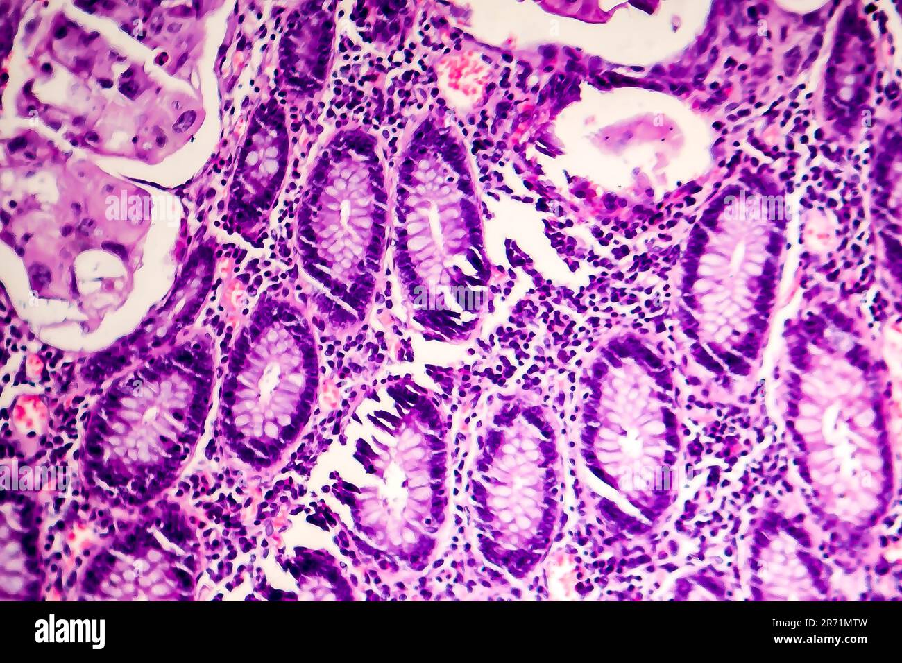 Poorly differentiated intestinal adenocarcinoma, light micrograph ...