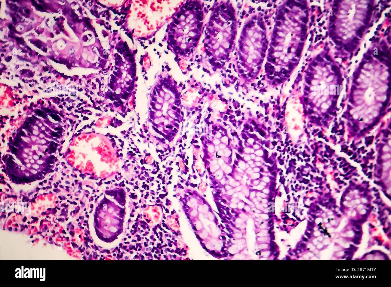 Poorly differentiated intestinal adenocarcinoma, light micrograph ...
