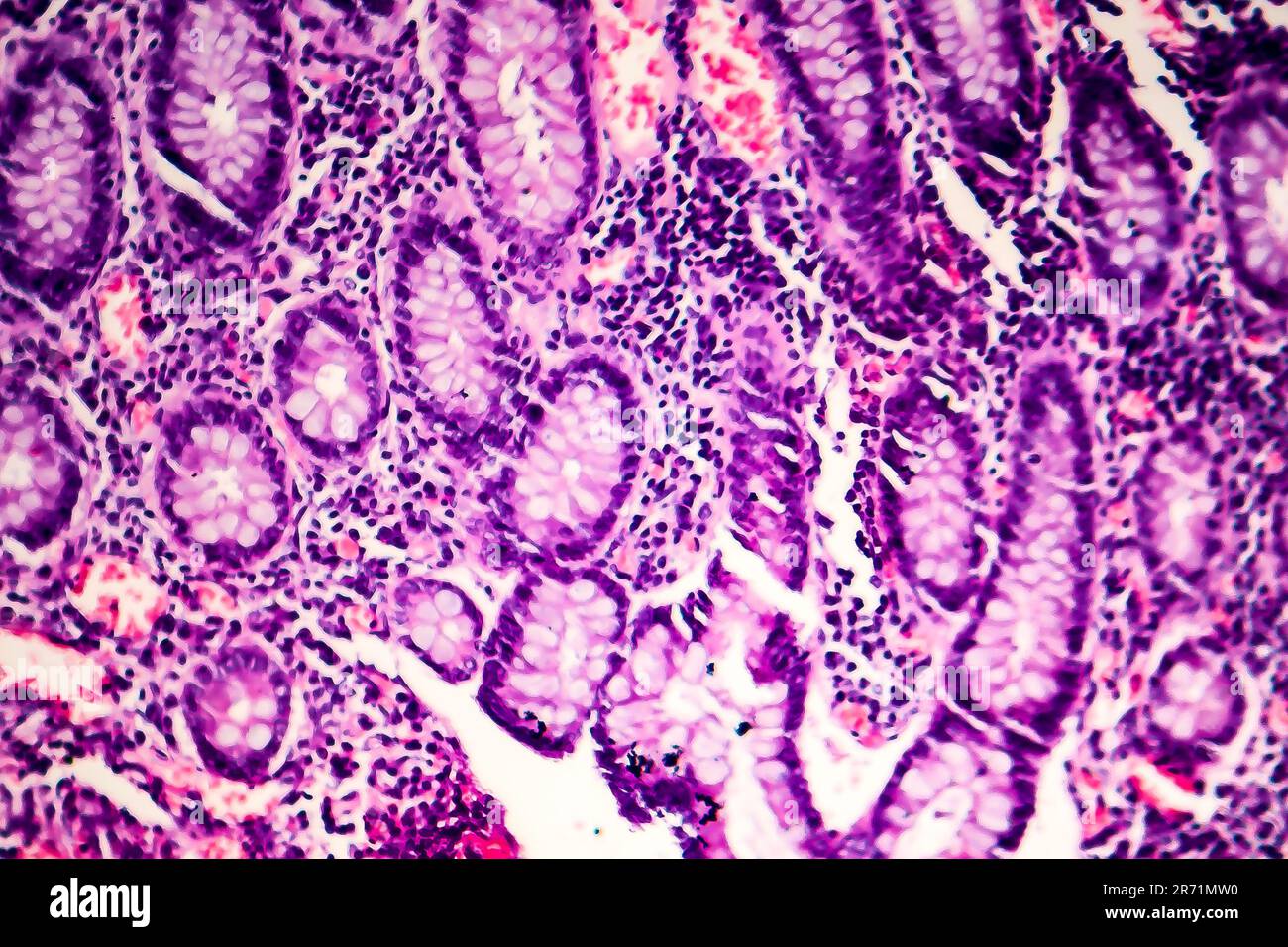Poorly differentiated intestinal adenocarcinoma, light micrograph ...