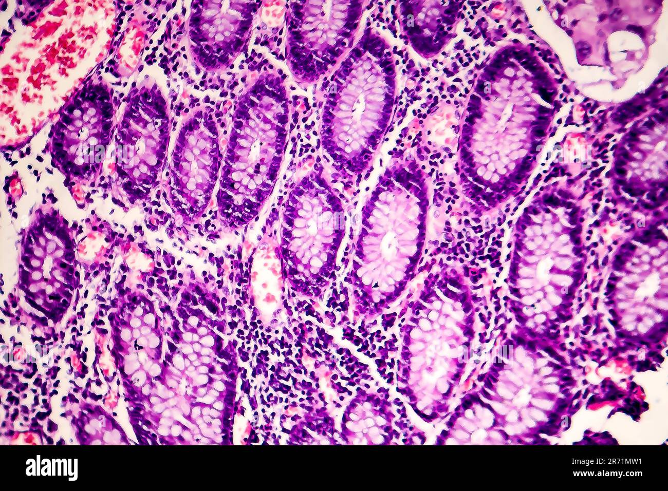 Poorly differentiated intestinal adenocarcinoma, light micrograph ...
