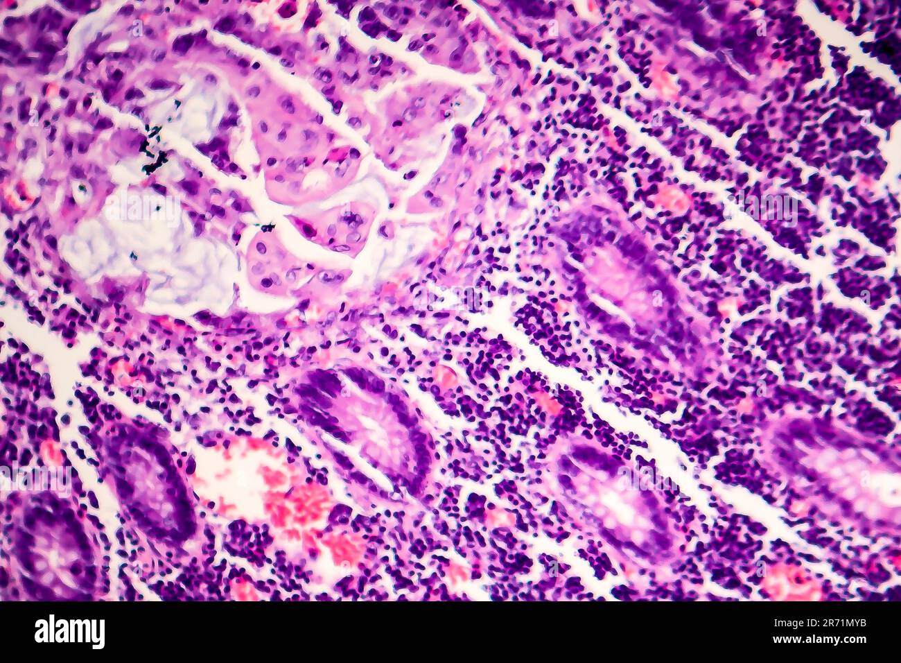 Poorly differentiated intestinal adenocarcinoma, light micrograph ...